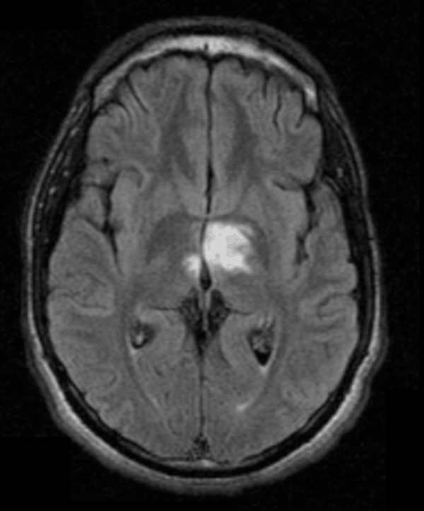 FULL TEXT - Community acquired methicillin sensitive Staphylococcus ...
