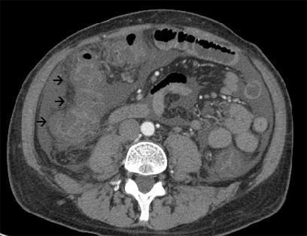 FULL TEXT - Unusual case of ascites - International Journal of Case ...