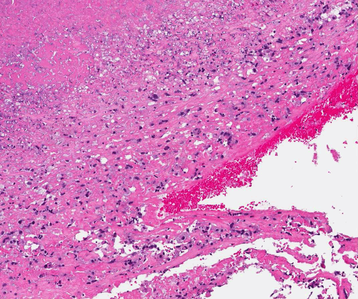 FULL TEXT - Intimal angiosarcoma of the thoracic aorta - International ...