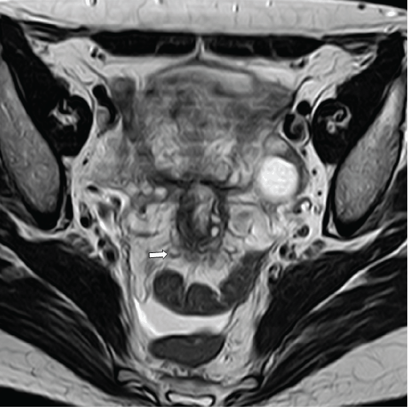 FULL TEXT - Magnetic resonance imaging features of vaginal ...
