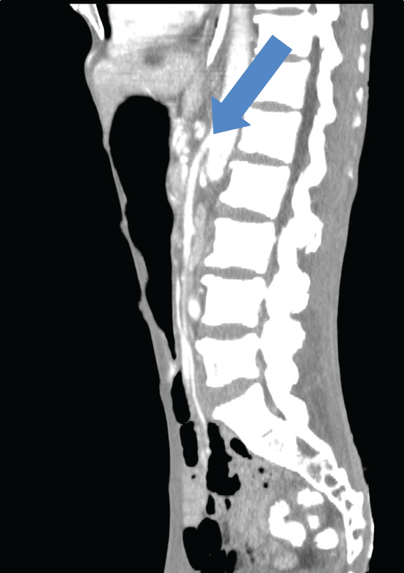 FULL TEXT - Superior mesenteric artery syndrome: A rare case of bowel ...