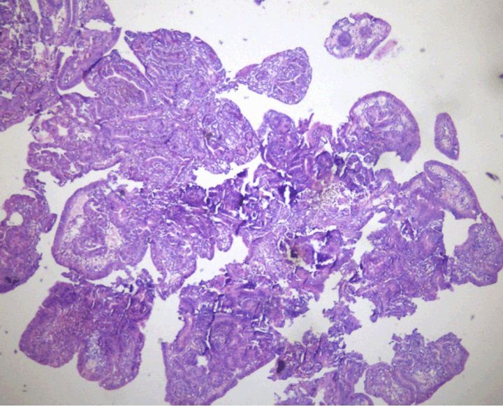 FULL TEXT - Gastric outlet obstruction due to a giant antral polyp ...