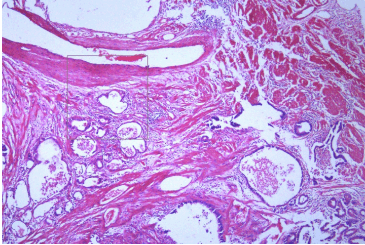 FULL TEXT - Gastric outlet obstruction due to a giant antral polyp ...
