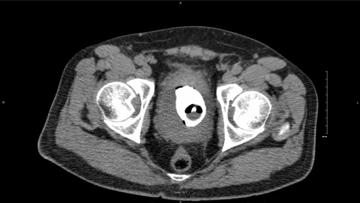 FULL TEXT - An unusual consequence of urinary catheter neglect: A giant ...