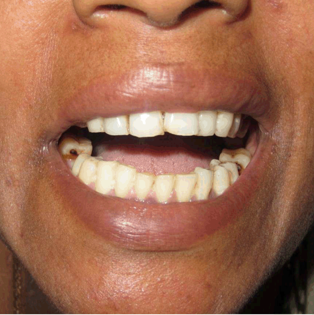 FULL TEXT - Osteochondroma of the mandibular condyle: A case report ...