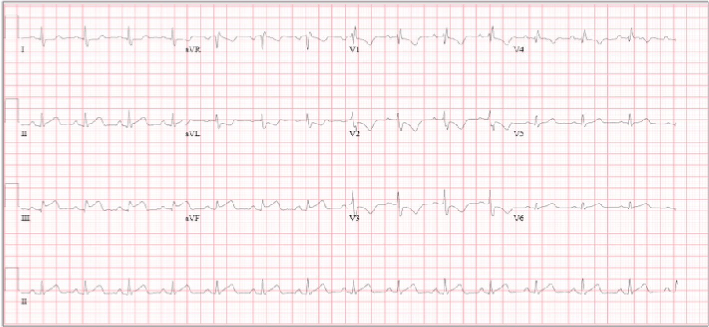FULL TEXT - ST-elevation myocardial infarction secondary to paradoxical ...