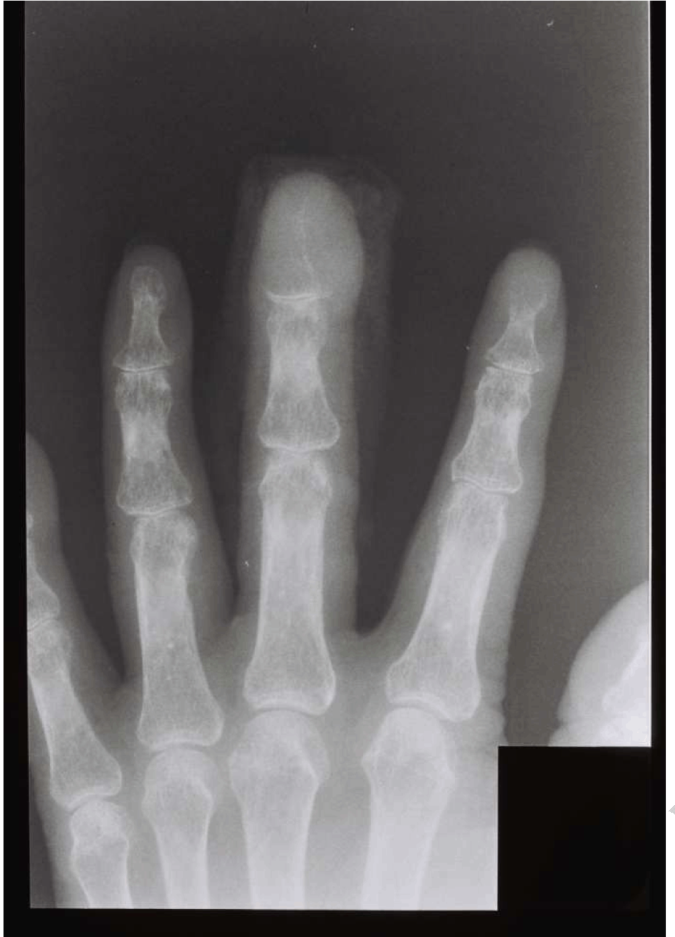 FULL TEXT - A rare case of finger metastasis showing as the first sign ...