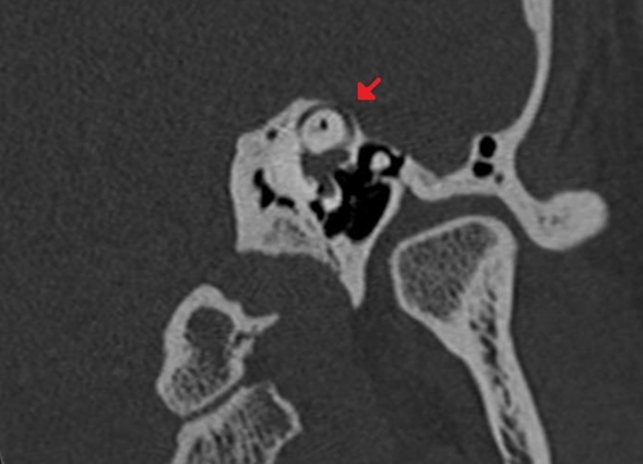 FULL TEXT - Superior semicircular canal dehiscence syndrome: A rare ...