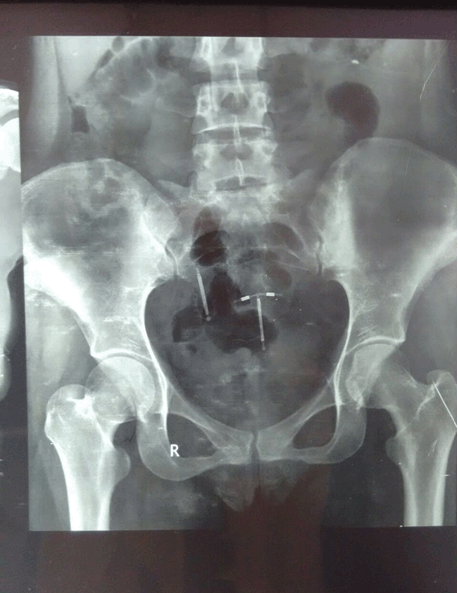 FULL TEXT - Diagnosis and management of two intrapelvic mislocated ...