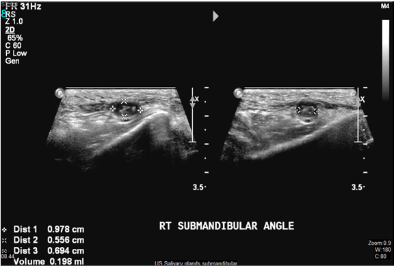 FULL TEXT - An acute presentation of paragonimiasis within masseteric ...