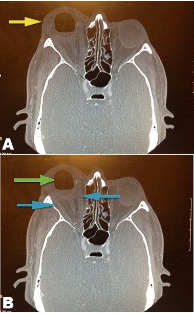 FULL TEXT - Severe proptosis due to infection - International Journal ...