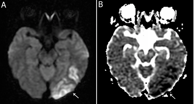 FULL TEXT - Stroke after blood patch in a patient with postpartum ...