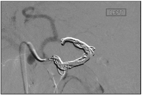 FULL TEXT - Rare presentation of a massive intermittent upper ...
