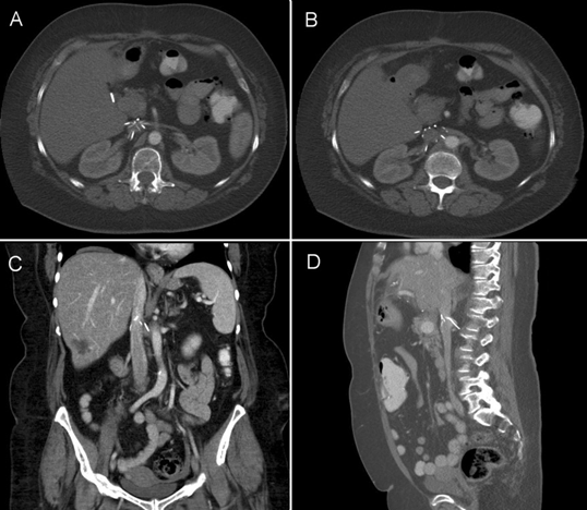 FULL TEXT - Perforated inferior vena cava filter removal by concurrent ...
