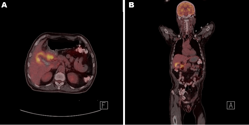 FULL TEXT - Xanthogranulomatous cholecystitis: The great gallbladder ...