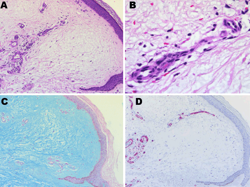FULL TEXT - Bilateral superficial angiomyxomas of lower limbs: Unique ...