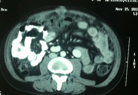 FULL TEXT - Umbilical metastasis as a primary presentation in carcinoma ...