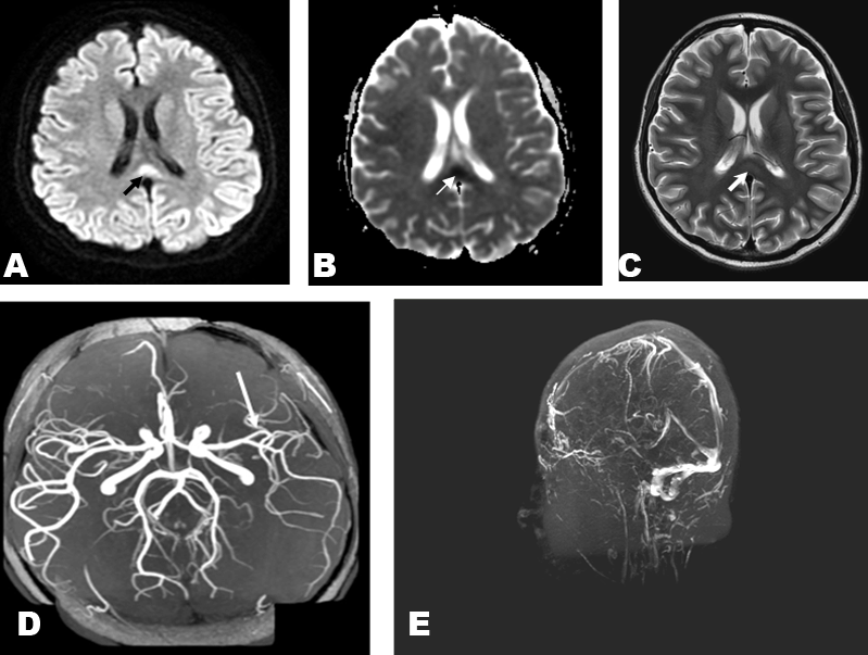 FULL TEXT -A unique case of neurological manifestation of hemolytic ...