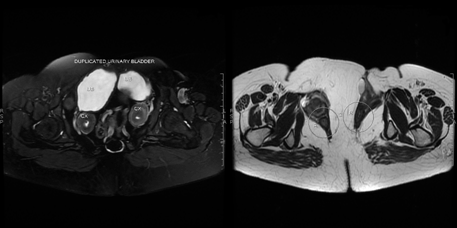 FULL TEXT -Complete urogenital and colonic duplication: An extremely ...