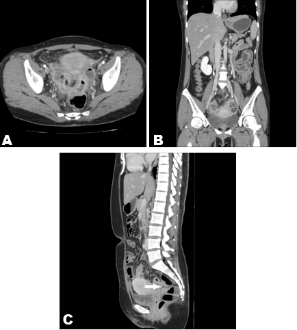 FULL TEXT -Sigmoid colon fistula with tubo-ovarian pelvic abscess: A ...