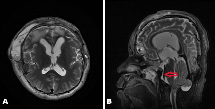 FULL TEXT -Successful endoscopic third ventriculostomy after ...