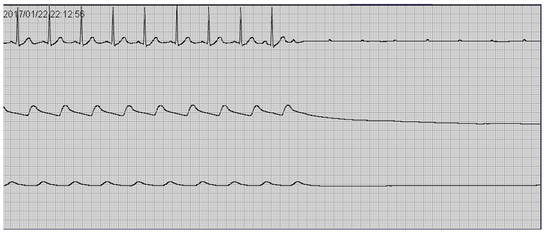 FULL TEXT -Cardiac arrest after intravenous infusion of fosphenytoin ...