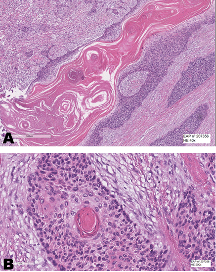 Squamous Cell Carcinoma In The Stomach
