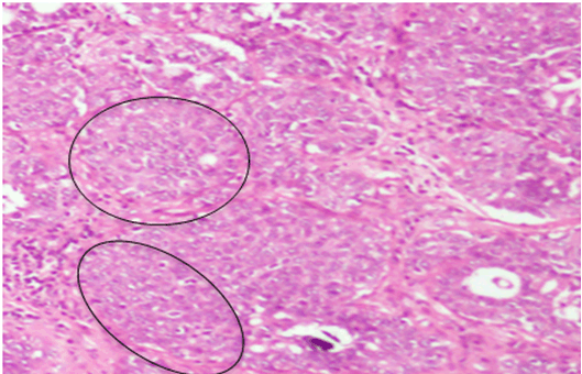 Ductal Carcinoma-in-situ within fibroadenoma of the breast: A case ...