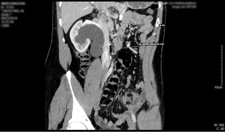A rare cause of hydronephrosis: Retrocaval ureter - International ...