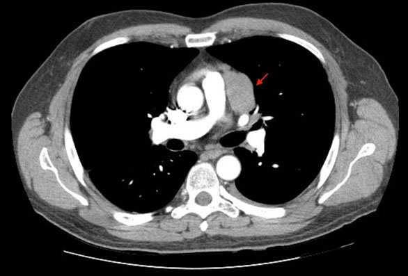 Pleural drop-metastasis five years post-thymectomy manifesting with ...