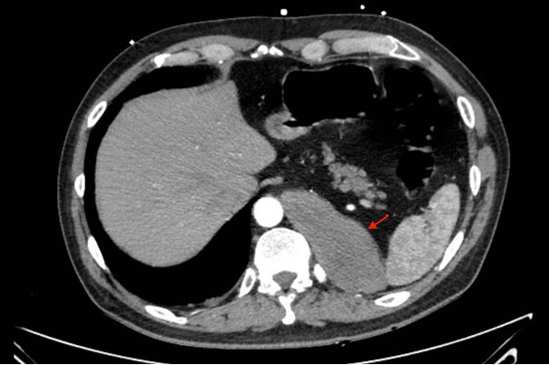 Pleural drop-metastasis five years post-thymectomy manifesting with ...