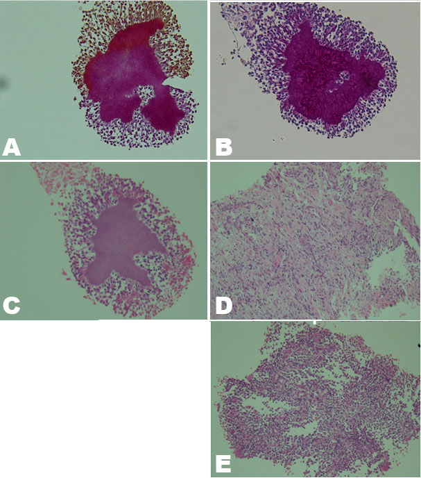 Actinomycosis or malignancy: A diagnostic dilemma - International ...