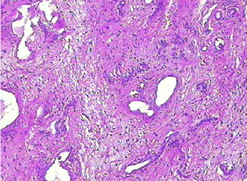 Superficial angiomyxoma of vulva: A case report - International Journal ...