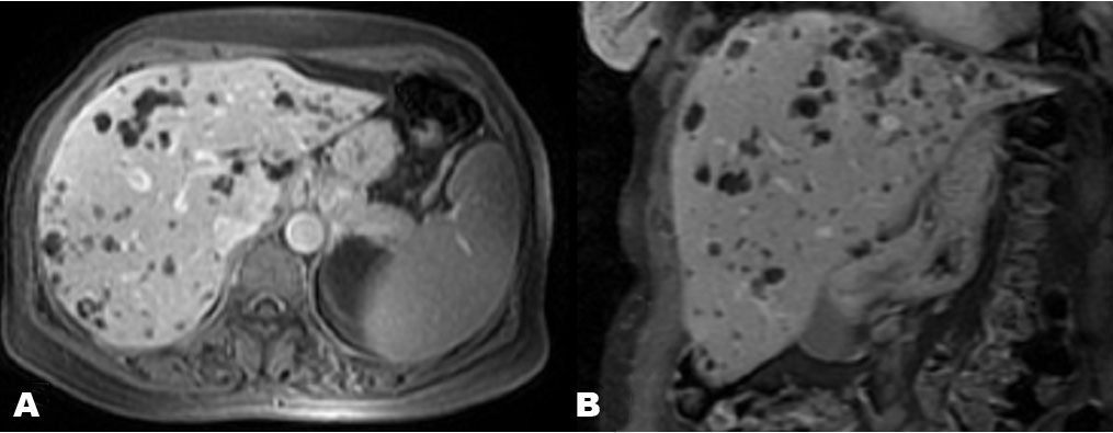 “Starry Sky Liver” on MR cholangiopancreatography - International ...