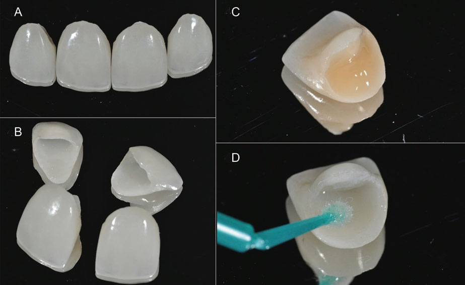 Esthetic rehabilitation with porcelain crowns using digital planning ...
