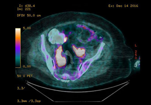 Anti-GD1b and anti-GM1 positive, acute inflammatory demyelinating ...