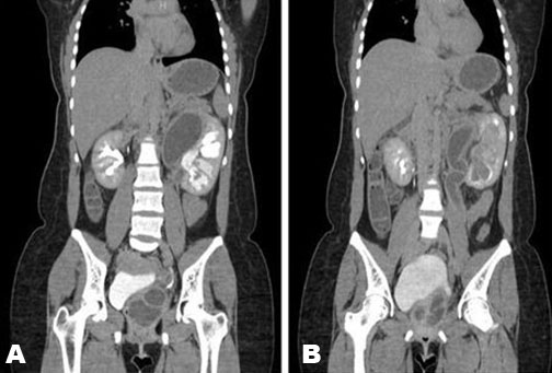 Vaginal ureterocele: Rare finding in complicated pyelonephritis ...