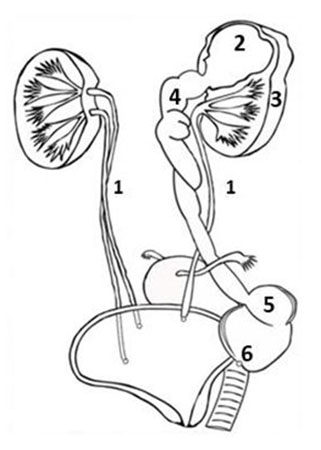 Vaginal ureterocele: Rare finding in complicated pyelonephritis ...