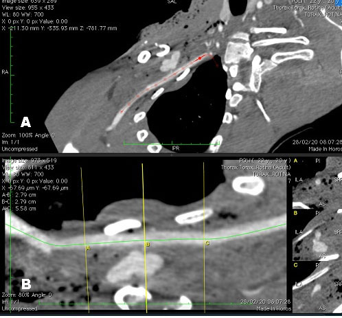 Right subclavian artery injury secondary to blunt trauma successfully ...