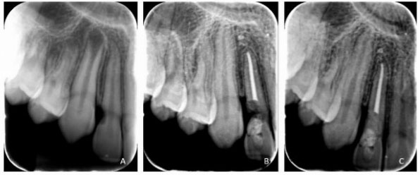 Maxillary anterior teeth with extensive root resorption treated with ...