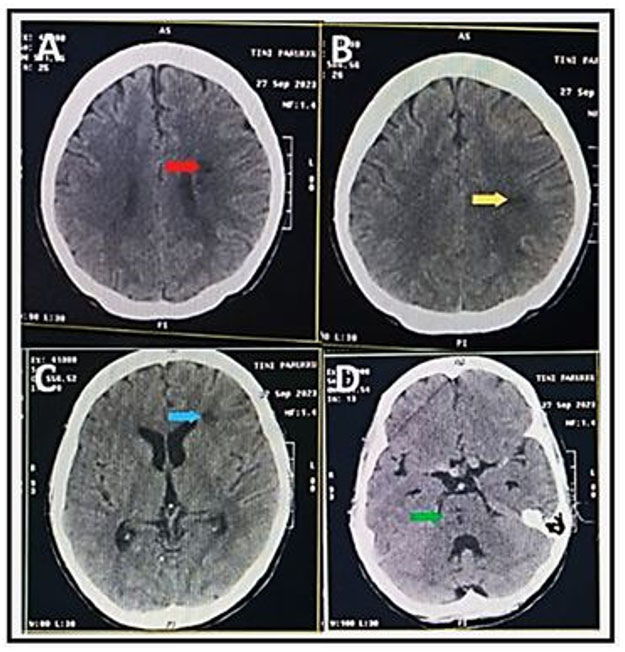 Cerebral angiography in anterior circulation ischemic stroke with ...