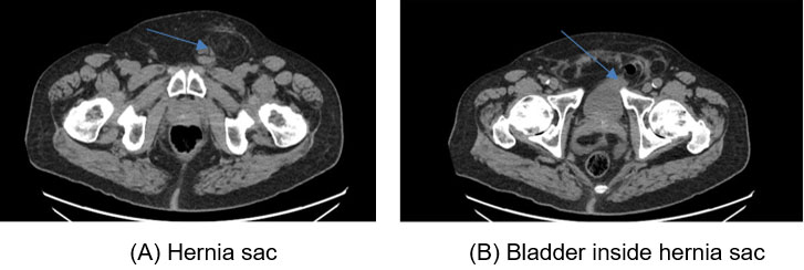 A case of inguinal hernia with partial bladder herniation ...