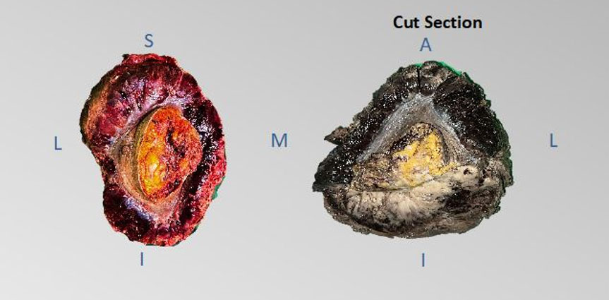 Larger than life: A case of a bleeding giant phyllodes tumor in a COVID ...